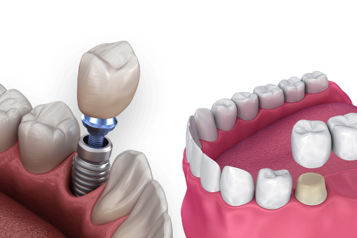 Dental Implants vs. Bridges: Which Is the Better Choice Dental Implants vs. Bridges: Which Is the Better Choice